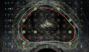 Prostate - Texas Radiotherapy